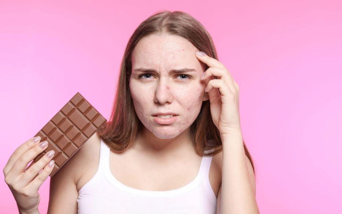 Chocolate causa acne? Saiba a verdade por trás dessa dúvida - Vale do ...